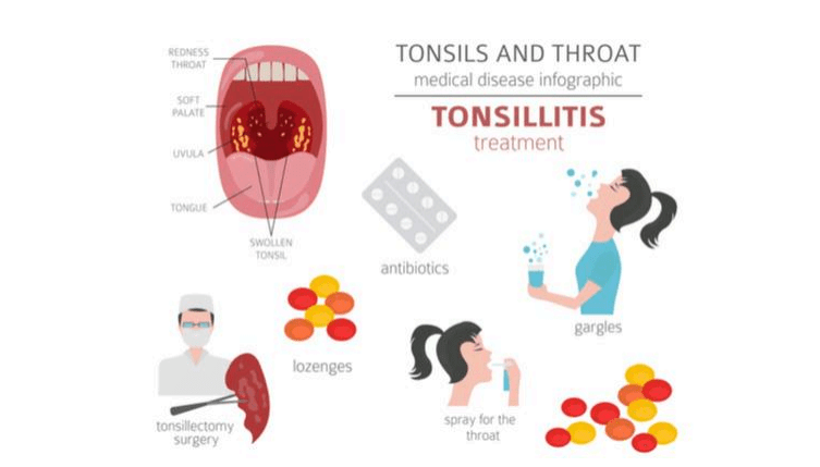 tonsillitis treatment