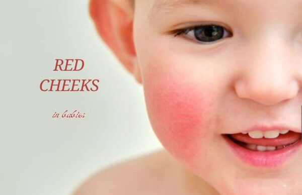 Red Cheeks in Babies: Causes, Symptoms, and Treatments